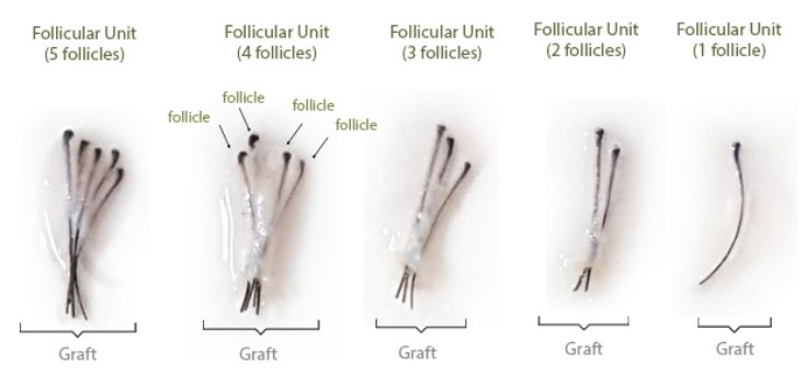 ¿Qué es una unidad folicular? - Tricología y Trasplante Capilar Mir
